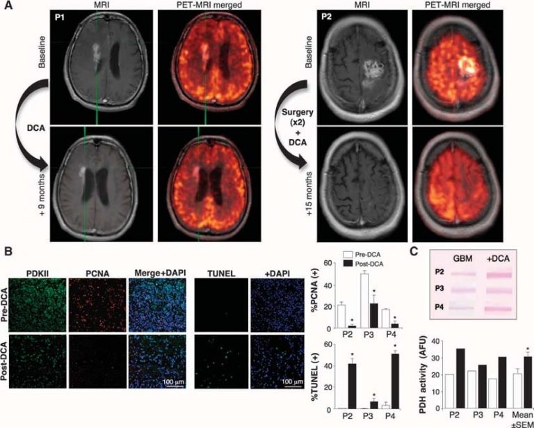 Metabole modulatie van glioblastoom met dichlooracetaat | DCA Guide